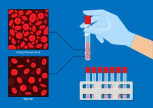 What Is Polycythemia Vera? | PV Reporter